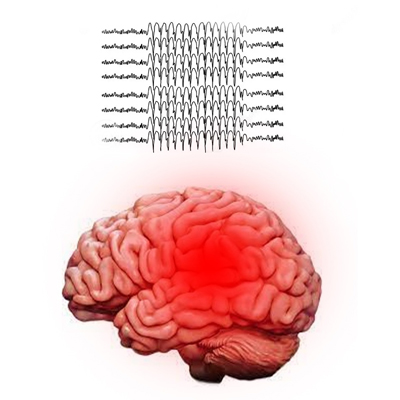 What to Do at the Time of an Epilepsy Attack, A Guide by Dr. Sandeep ...